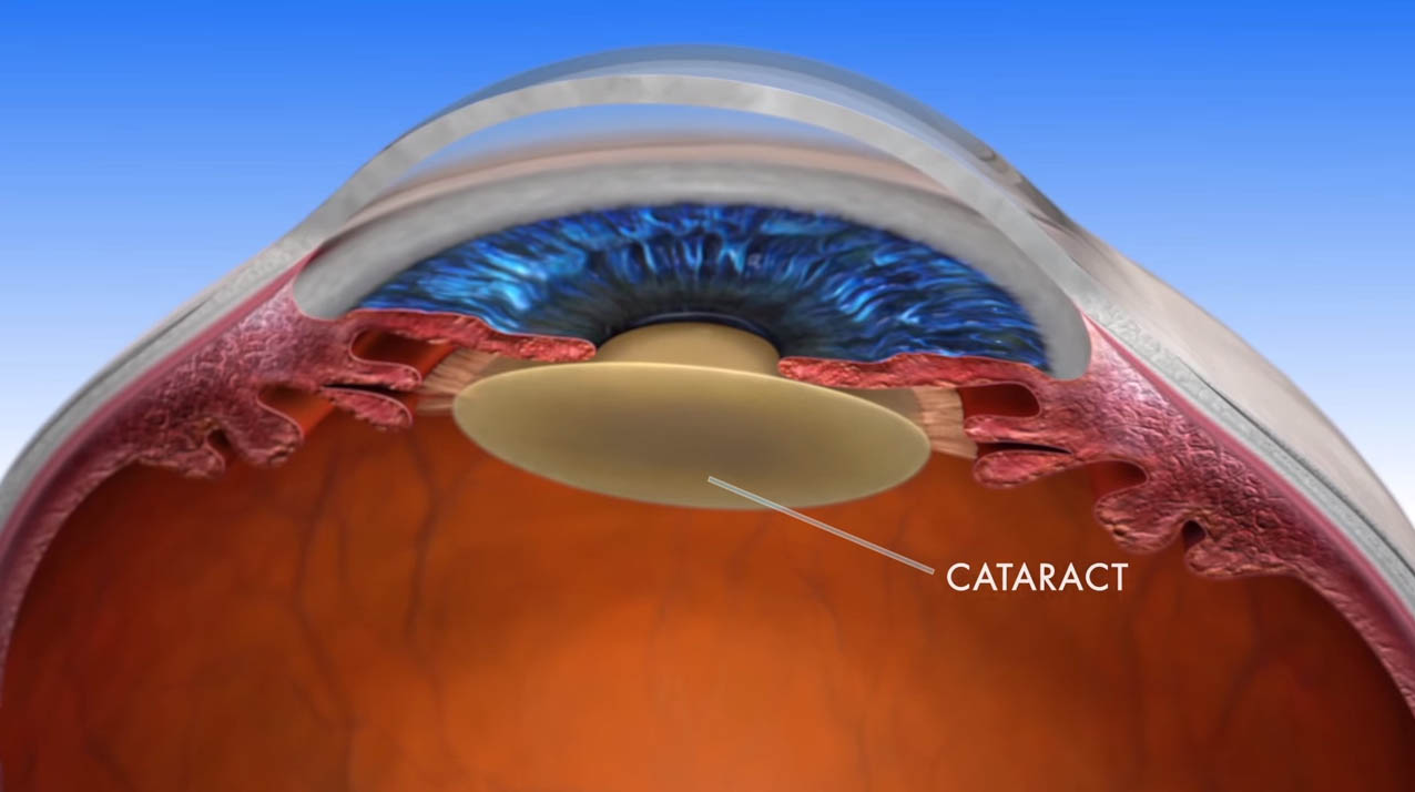 Cataract Services - Pragati India Eye Care Society